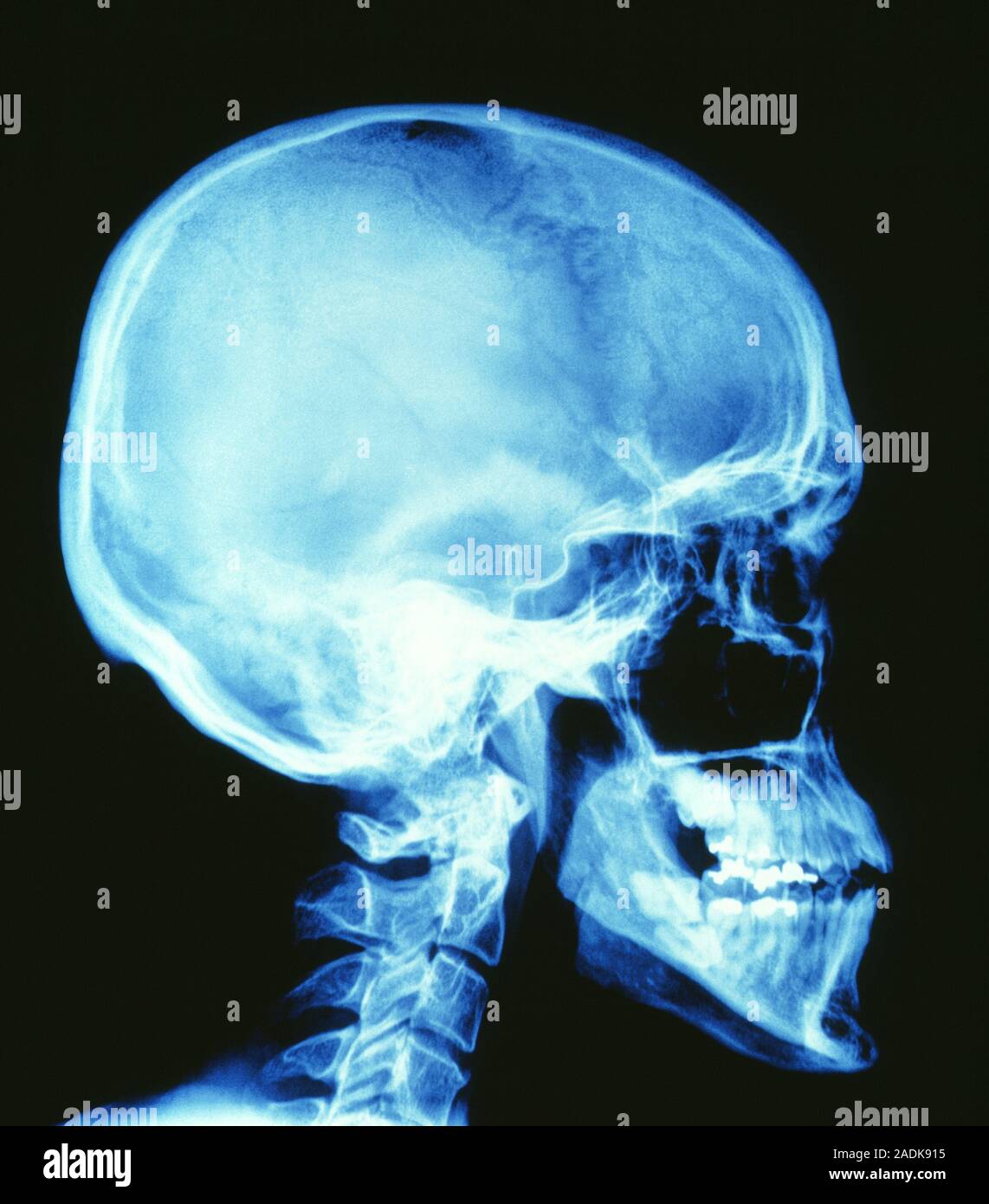 Skull. Coloured X-ray of a healthy human skull seen from the side. The ...