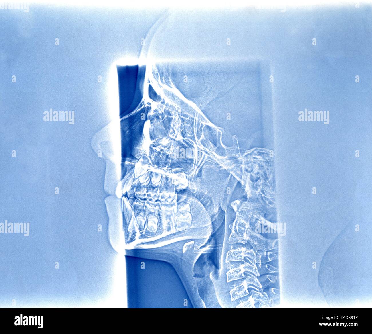 Human skull. Computer artwork of an X-ray of the facial bones of a ...