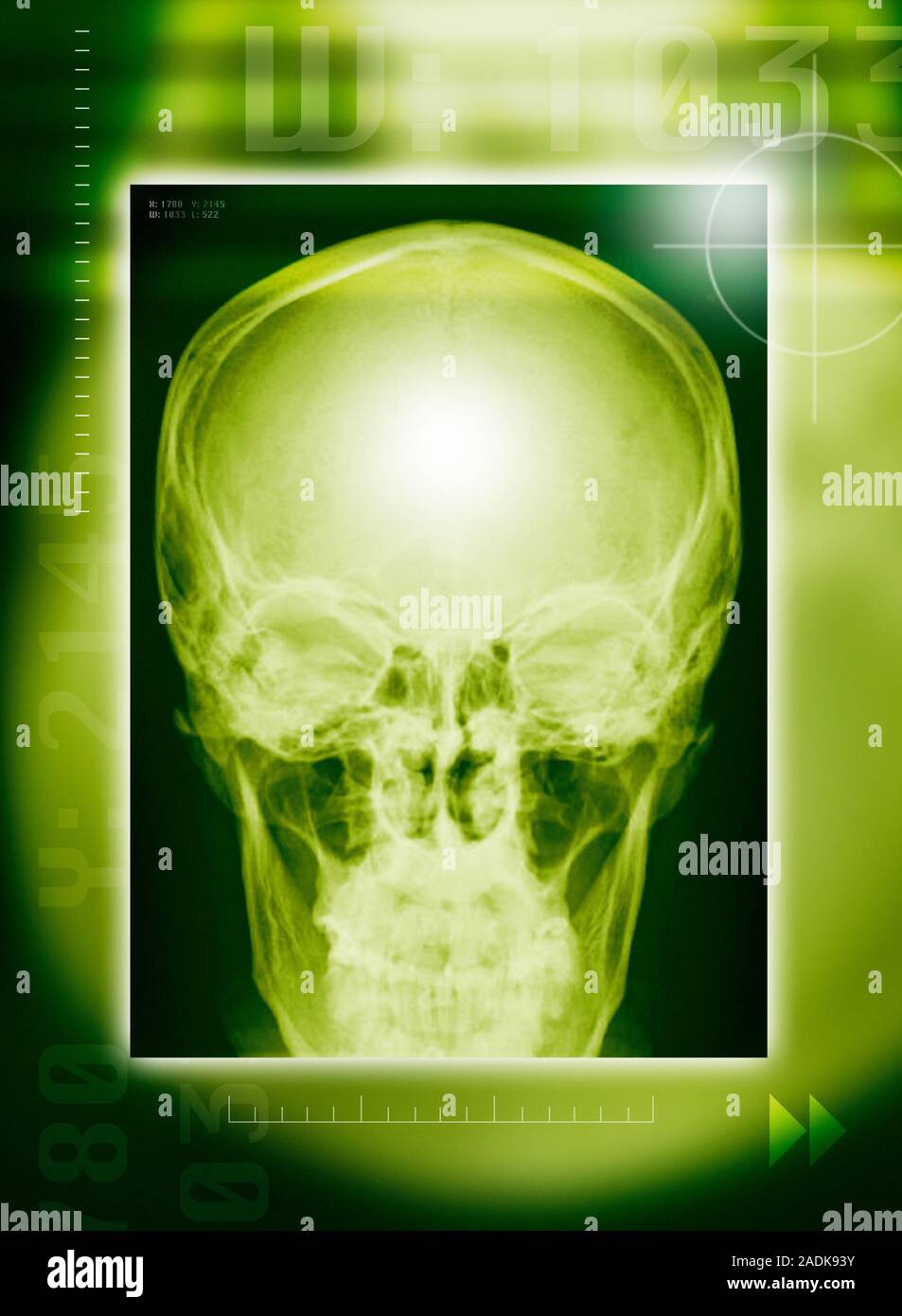 Skull. Coloured X-ray of a frontal view of a healthy skull. The bones ...