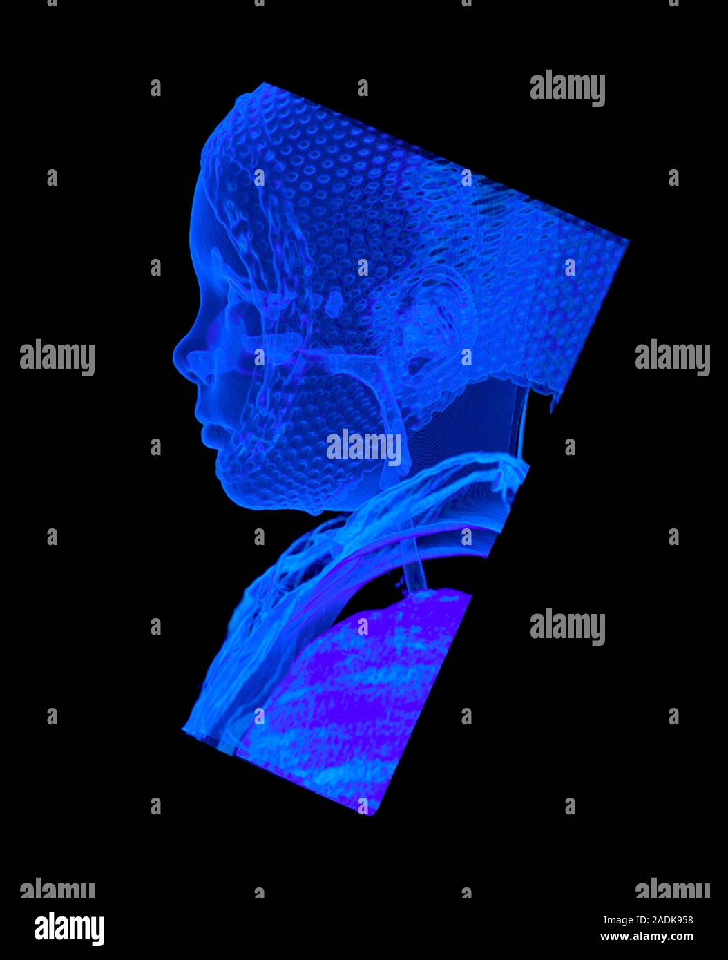 Child's head and chest, CT scan. Coloured 3-D computed tomography (CT ...