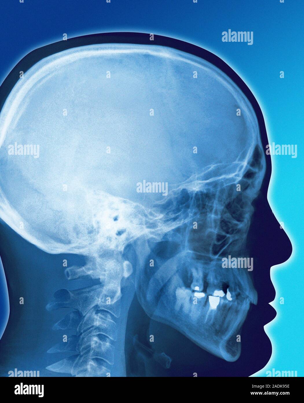 Healthy human skull. Side view X-ray showing the skull and the outline ...