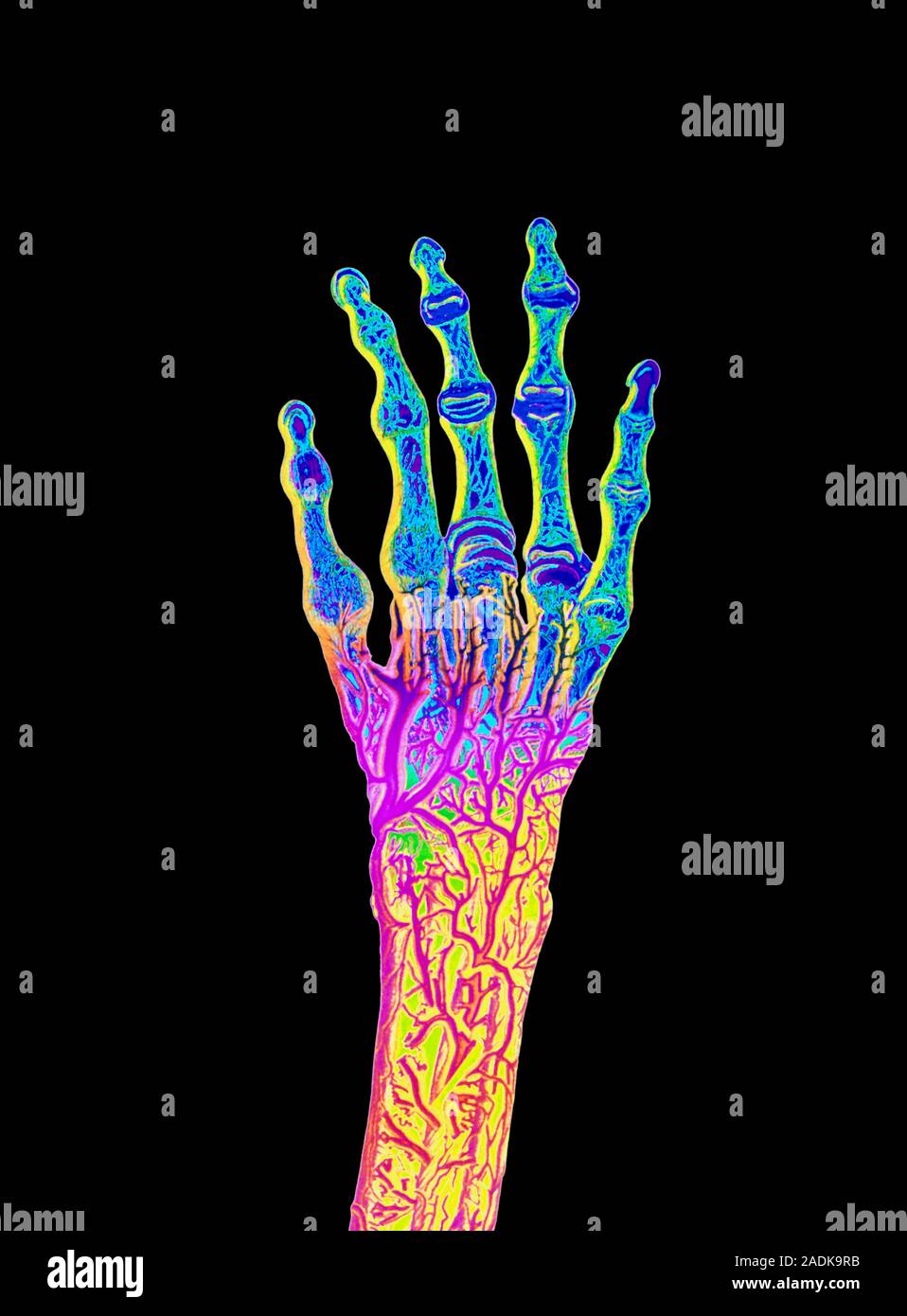 Hand. Computer-enhanced historical artwork of the blood supply to the ...