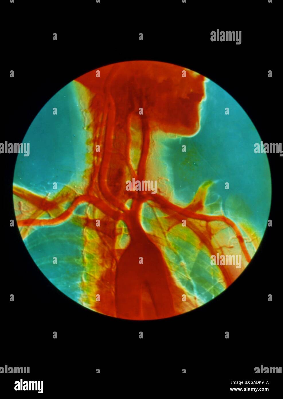 False-colour arteriograph (angiograph) of the arteries in the neck ...