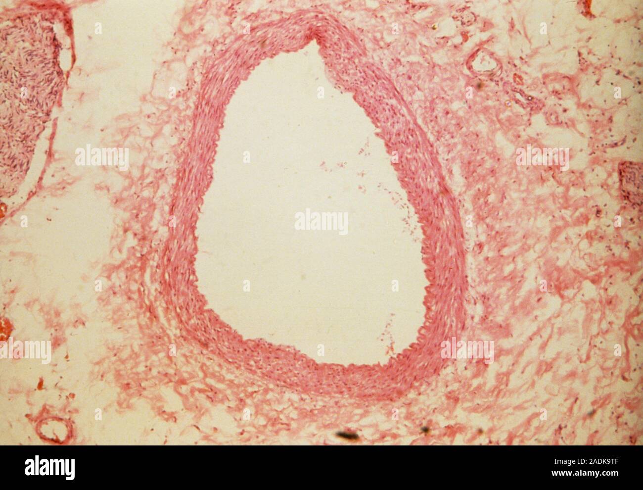 Light micrograph of a cross-section of a normal human coronary artery ...