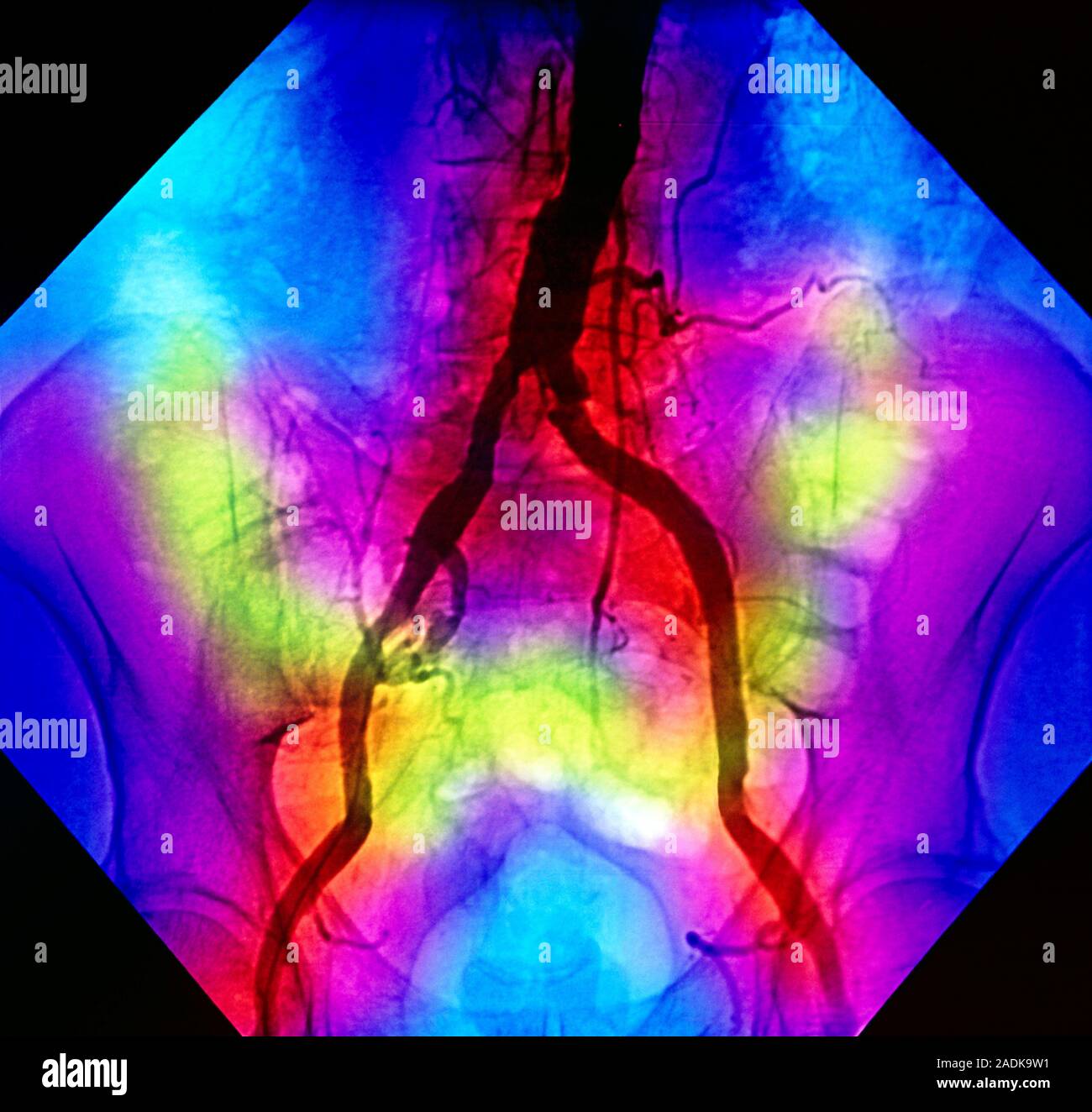 Normal abdominal angiogram: false-colour abdominal angiogram showing ...