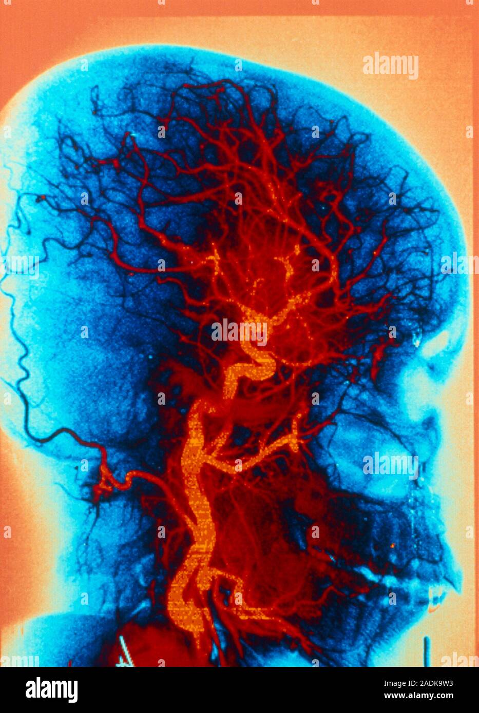 Blood vessels of the head. Digitised-colour angio- gram of the human ...