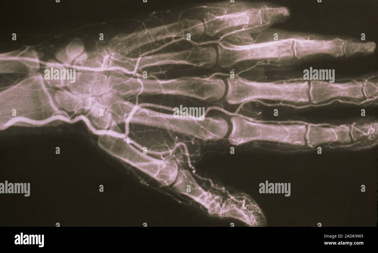 Arteriogram (angiogram) showing the network of arteries supplying the ...