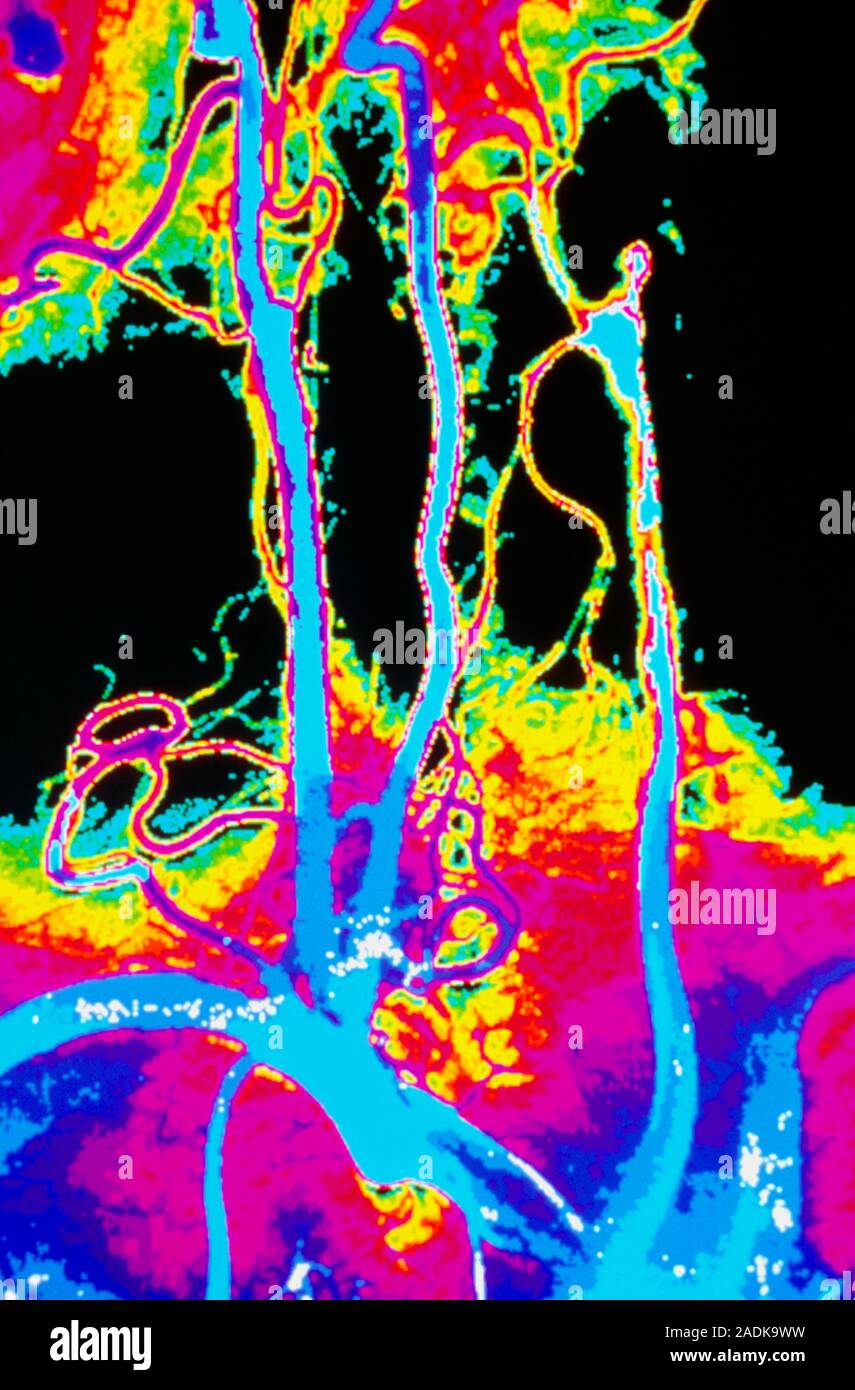 Neck arteries. Coloured X-ray angiogram of the human neck revealing ...