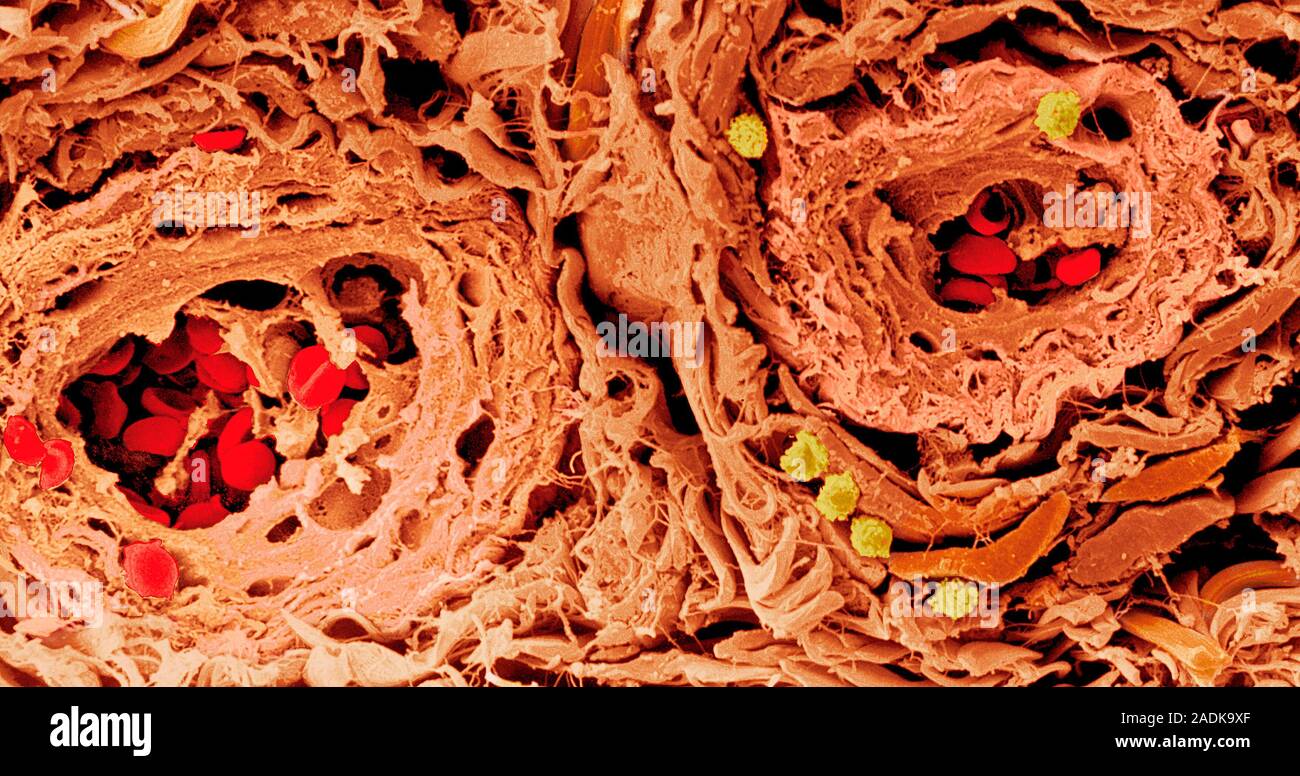 Skin blood vessels. Coloured scanning electron micrograph (SEM) of two ...