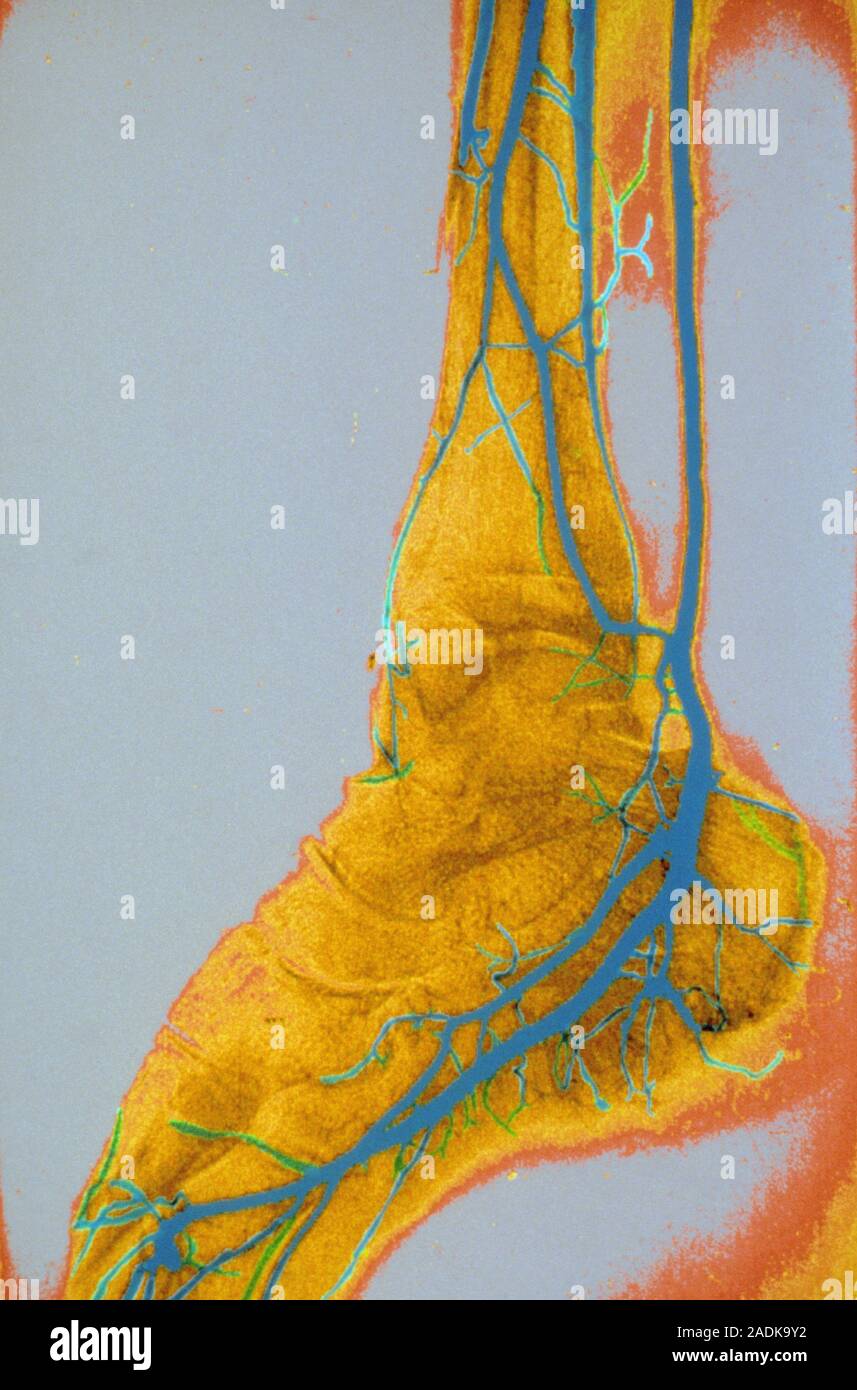 Arteries of the foot. Coloured arteriogram (angiogram) showing the ...