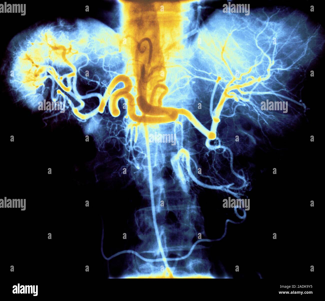 Hepatic & splenic arteries. Coloured angiogram (X- ray) of the upper ...