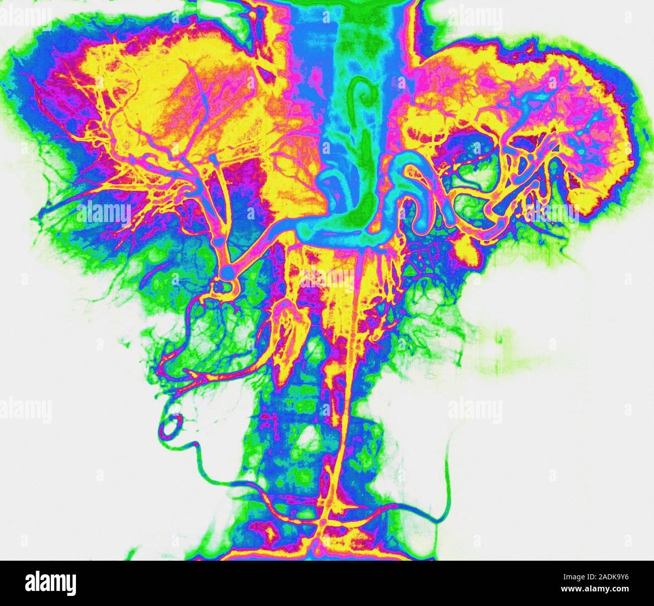 Hepatic & splenic arteries. Coloured angiogram (X- ray) of the upper ...
