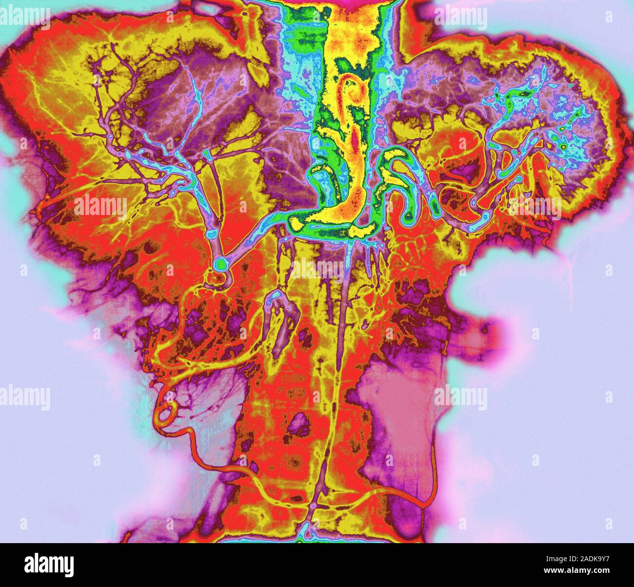 Hepatic & splenic arteries. Coloured angiogram (X- ray) of the upper ...