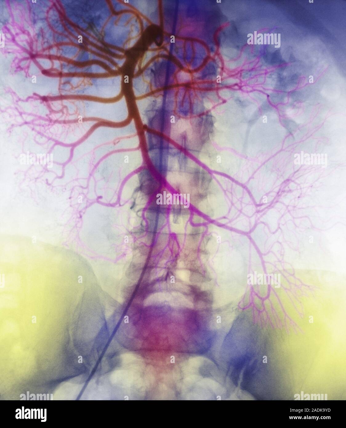 Mesenteric arteries. Coloured angiogram (X-ray) of the branching ...