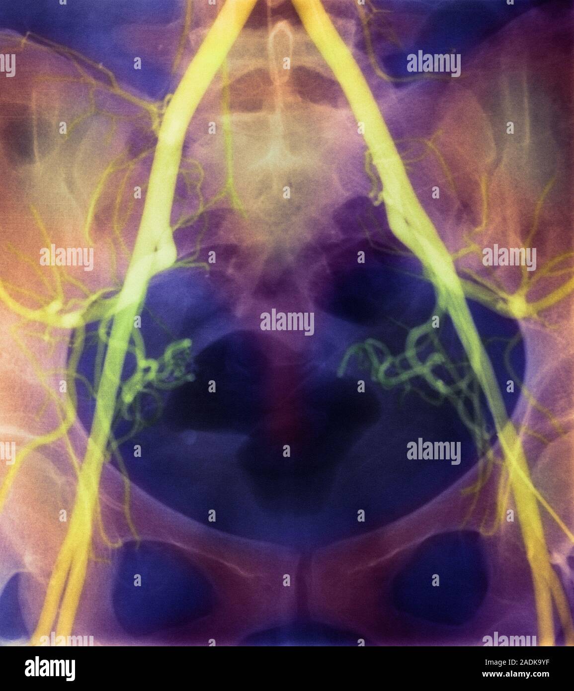 Blood supply to pelvis. Coloured arteriogram (X- ray) of normal human ...