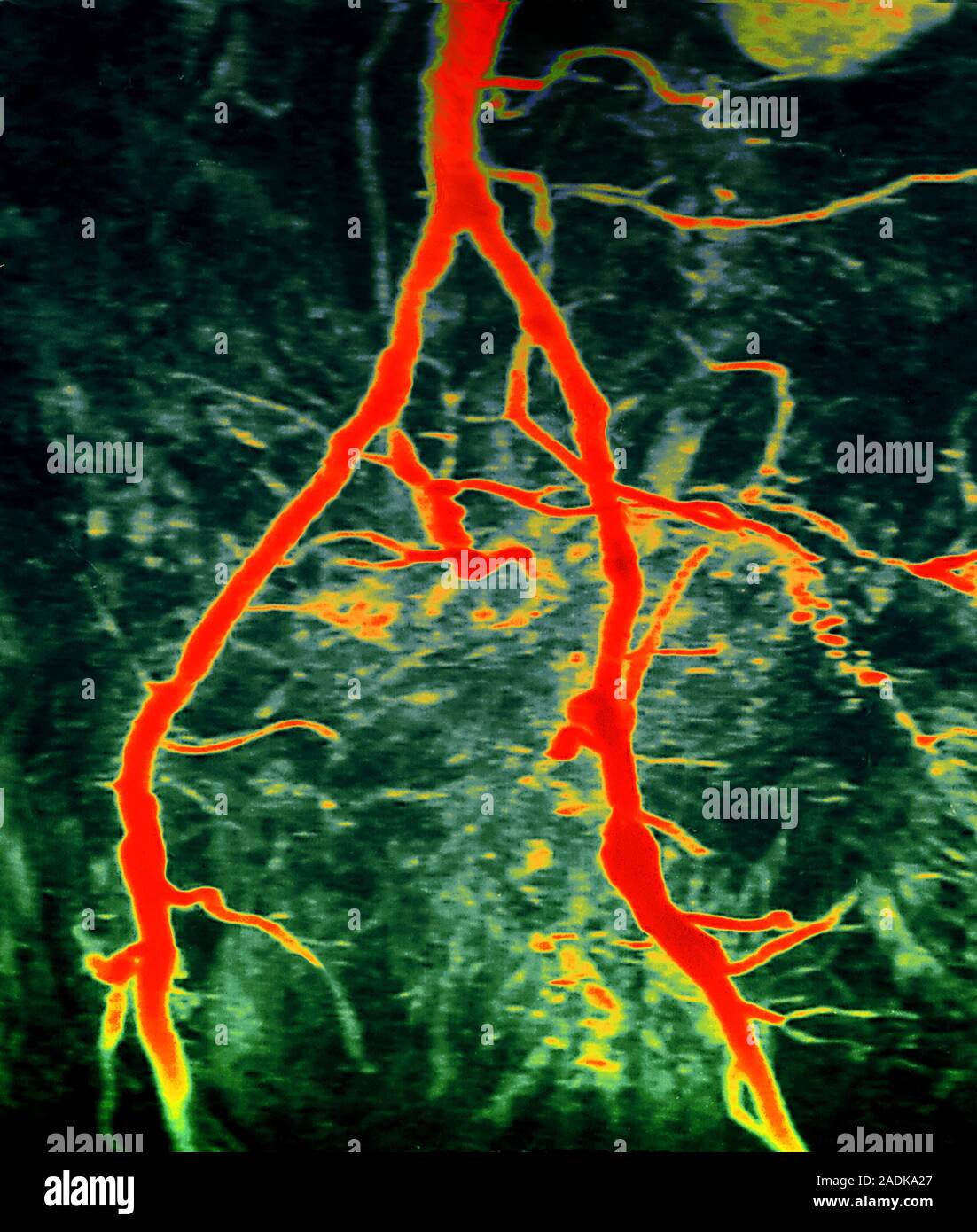 Groin arteries. Coloured coronal (frontal) MRA (magnetic resonance ...