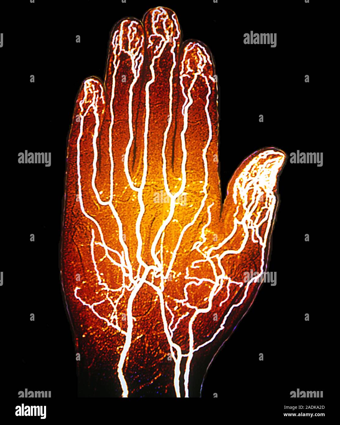 Hand arteries. Coloured X-ray angiogram of healthy arteries (white) in ...