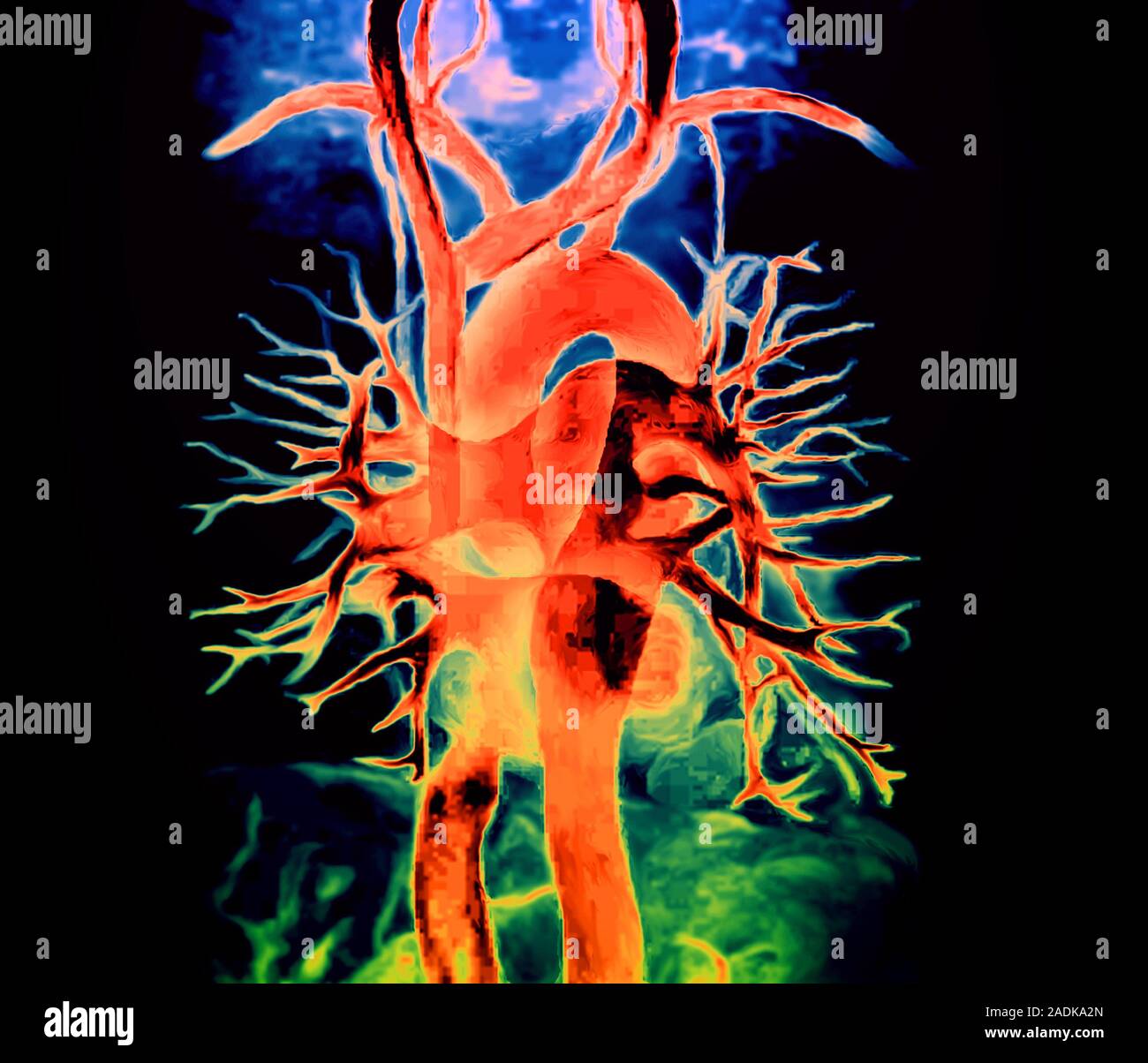 Chest blood vessels. Coloured 3-D magnetic resonance angiography (MRA ...