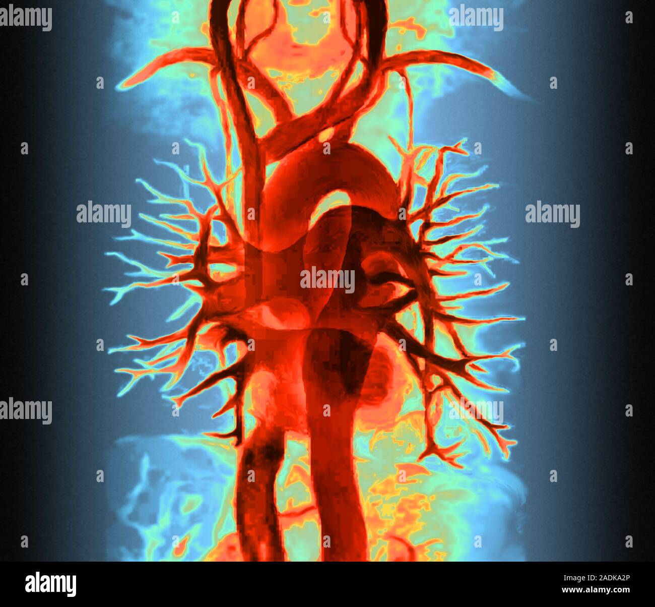 Chest blood vessels. Coloured 3-D magnetic resonance angiography (MRA ...