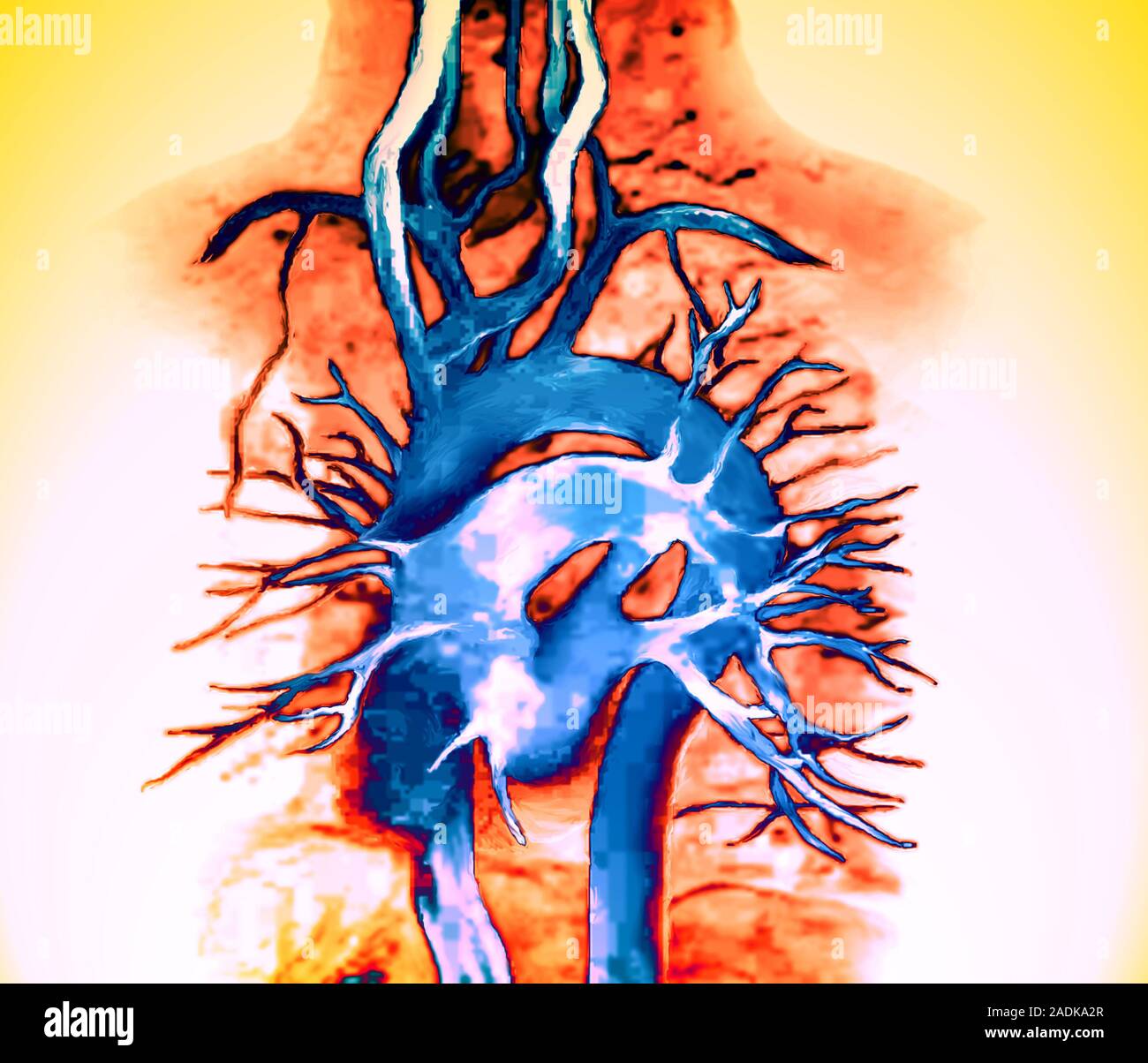 Chest blood vessels. Coloured 3-D magnetic resonance angiography (MRA ...