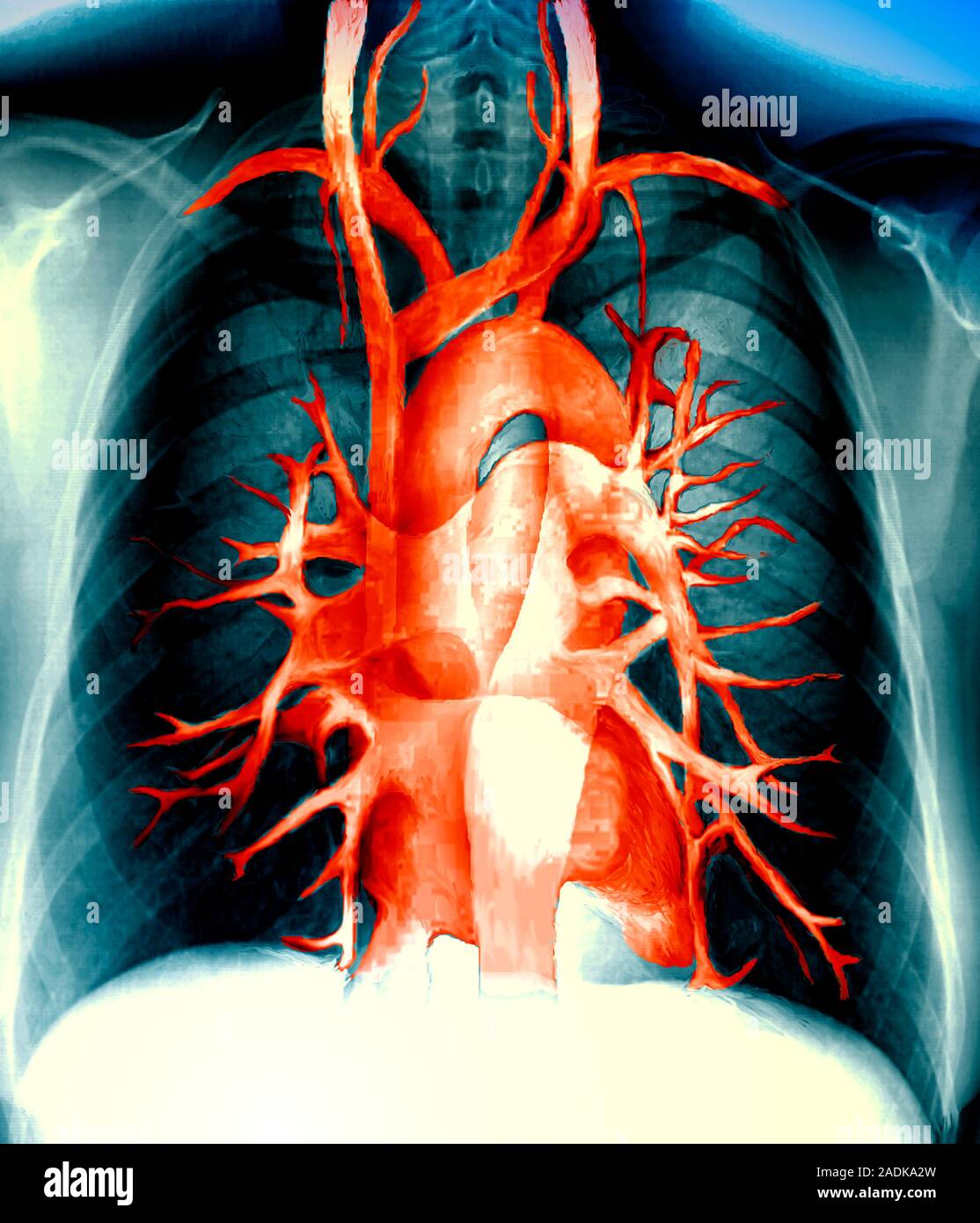 Chest blood vessels. Coloured composite of a 3-D magnetic resonance ...