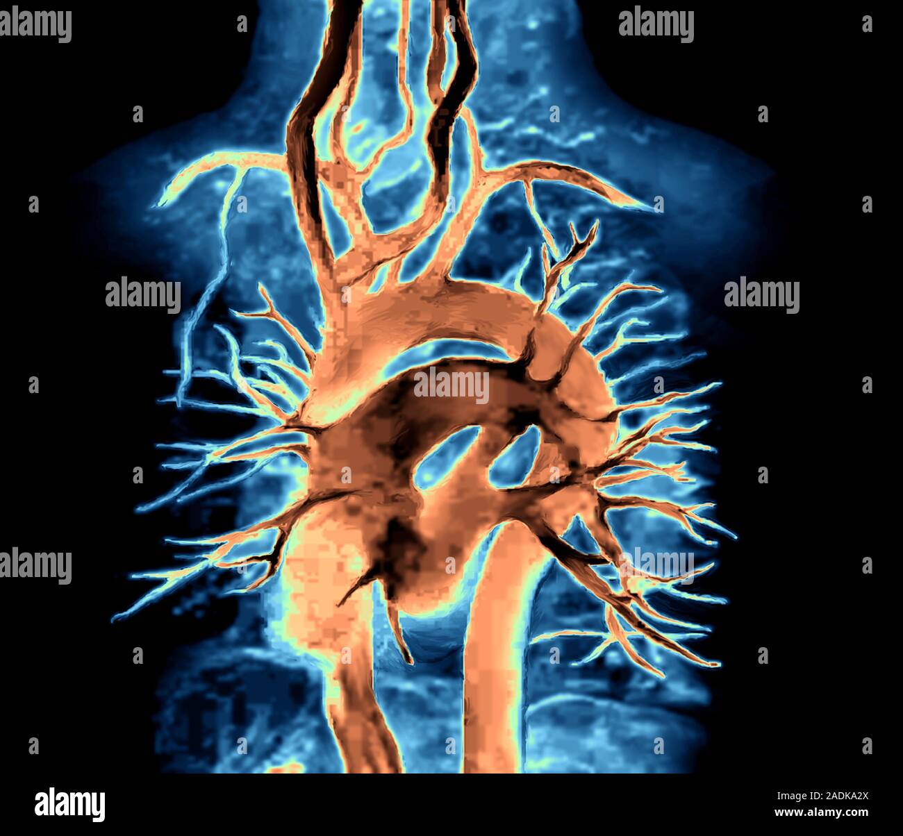 Chest blood vessels. Coloured 3-D magnetic resonance angiography (MRA ...