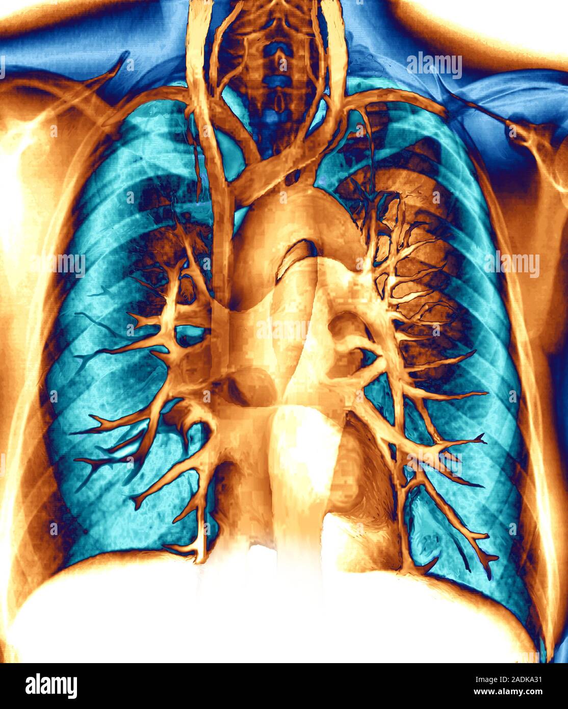 Chest blood vessels. Coloured composite of a 3-D magnetic resonance ...