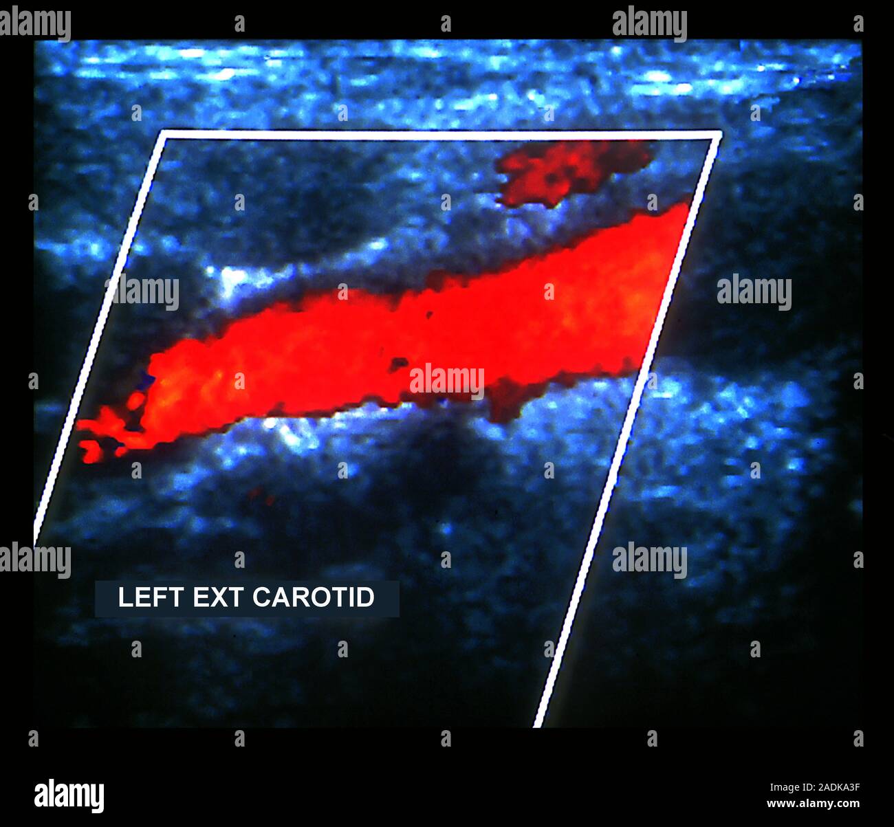 Arterial blood flow. Coloured Doppler ultrasound scan of healthy blood ...