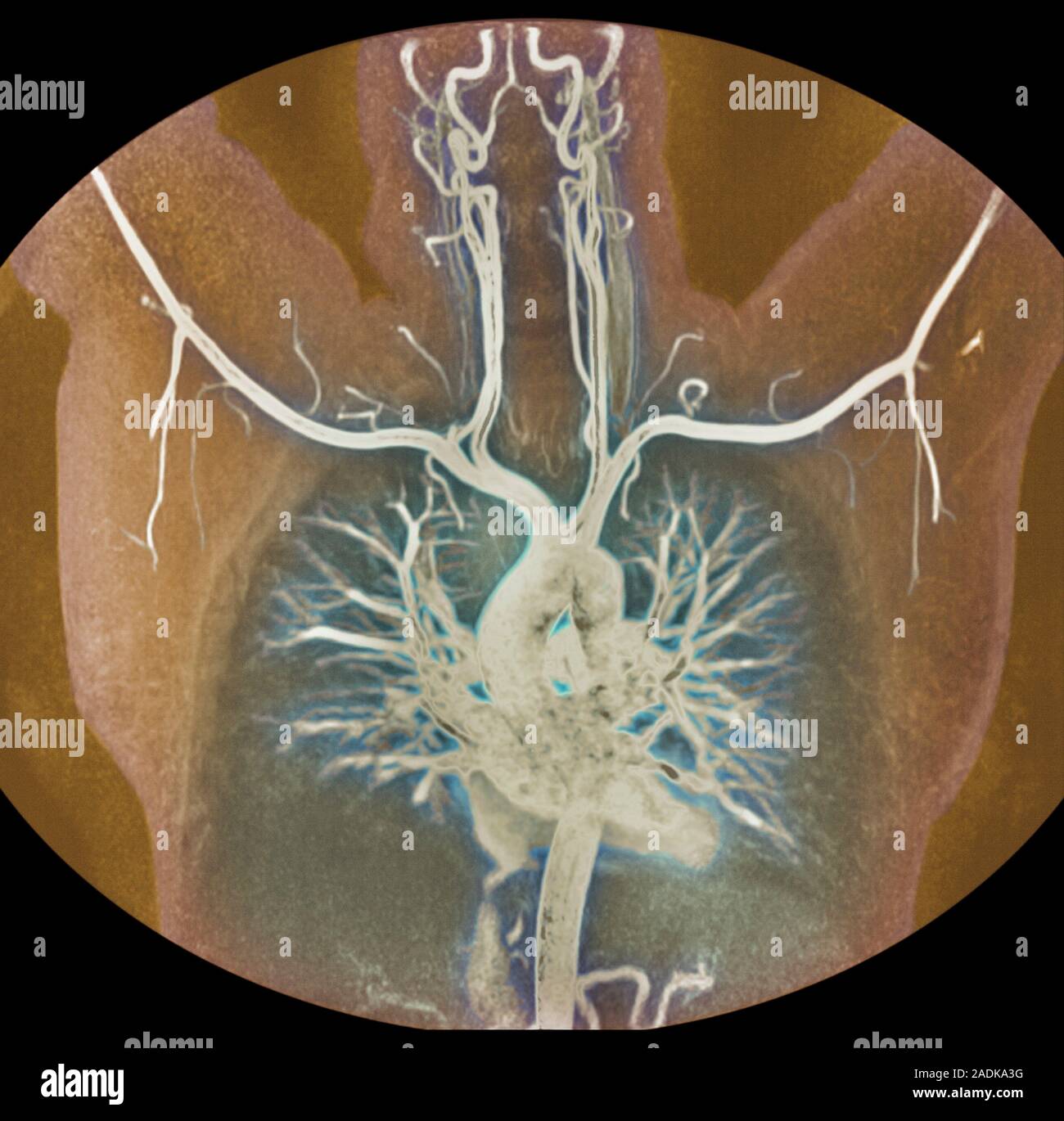 Chest and neck arteries (white), coloured magnetic resonance ...