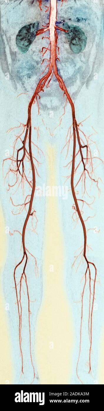 Leg and abdomen arteries (red), coloured magnetic resonance angiography ...