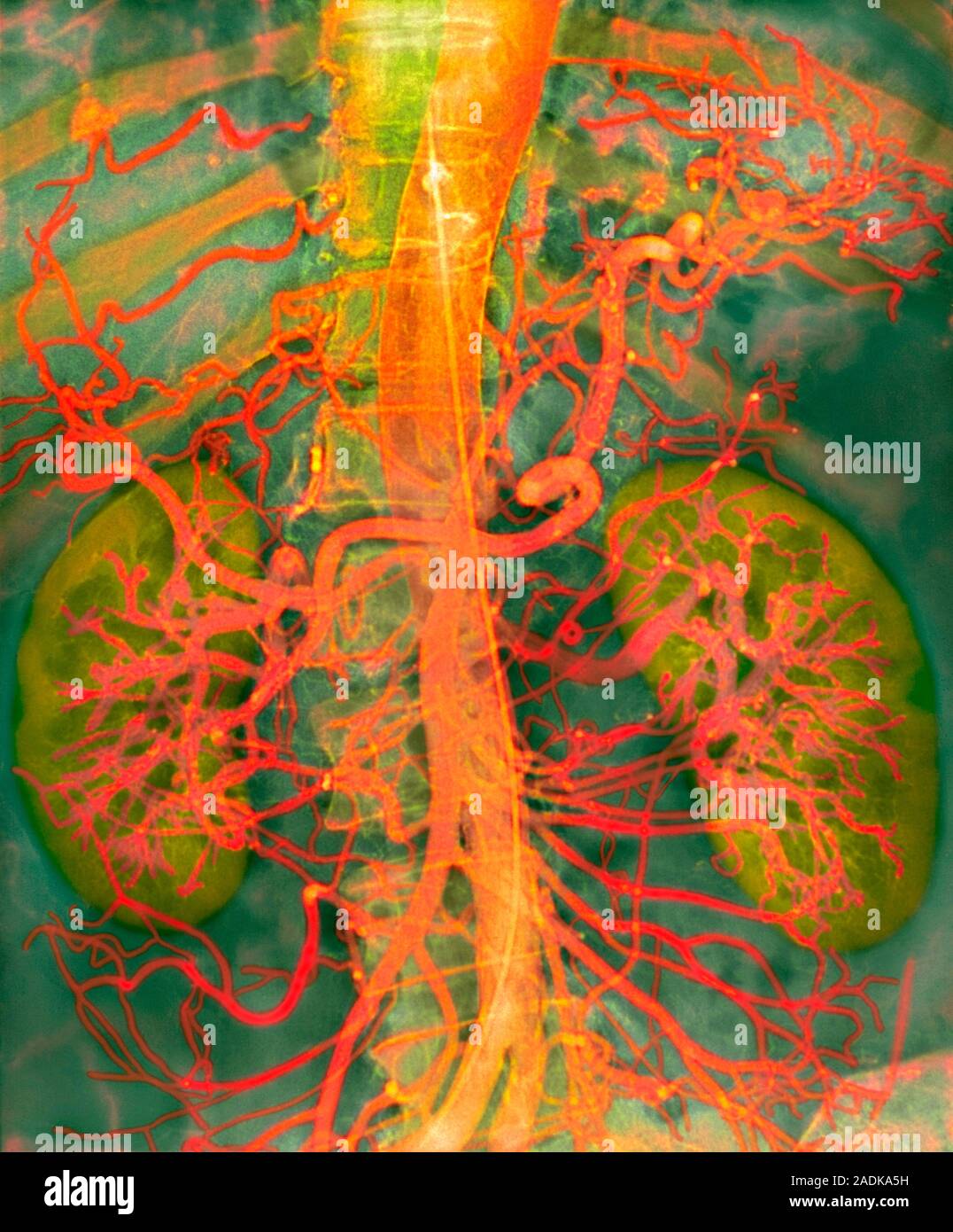 Abdominal arteries. Coloured angiogram of the arteries of the abdomen ...