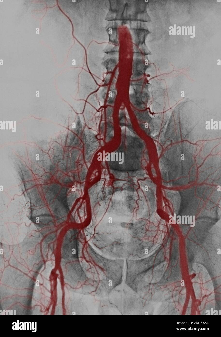 Abdominal arteries. Coloured angiogram of healthy iliac arteries. The ...