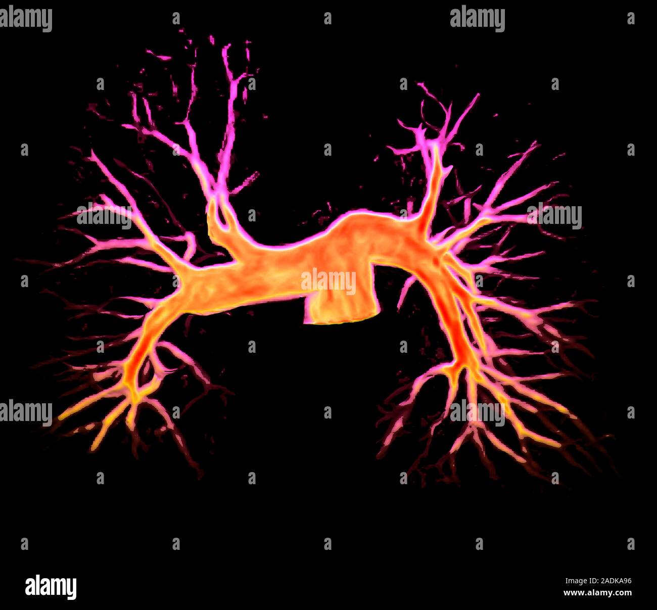 Pulmonary arteries. Coloured magnetic resonance imaging (MRI) scan of ...