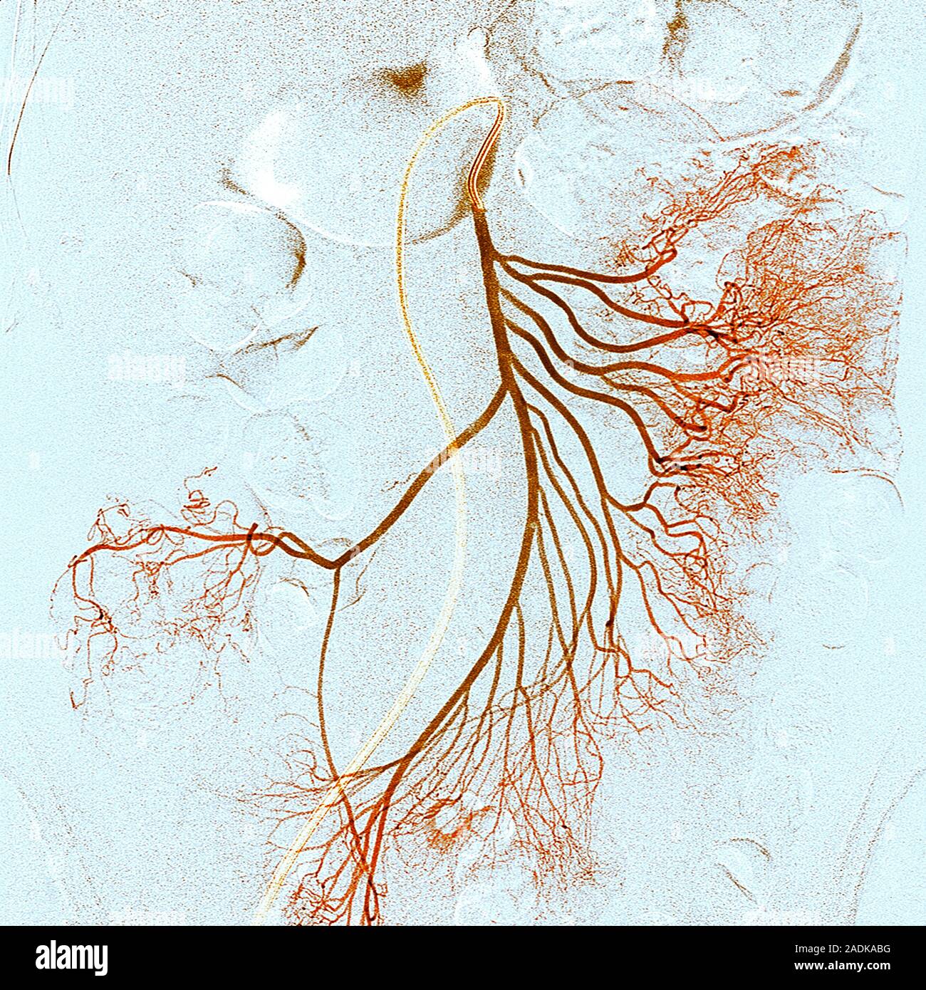 Abdominal blood vessels. Coloured X-ray of blood vessels branching from ...