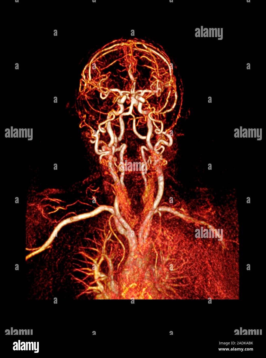 Head and neck arteries, CT scan. Coloured 3-D computed tomography (CT) scan showing only the ...
