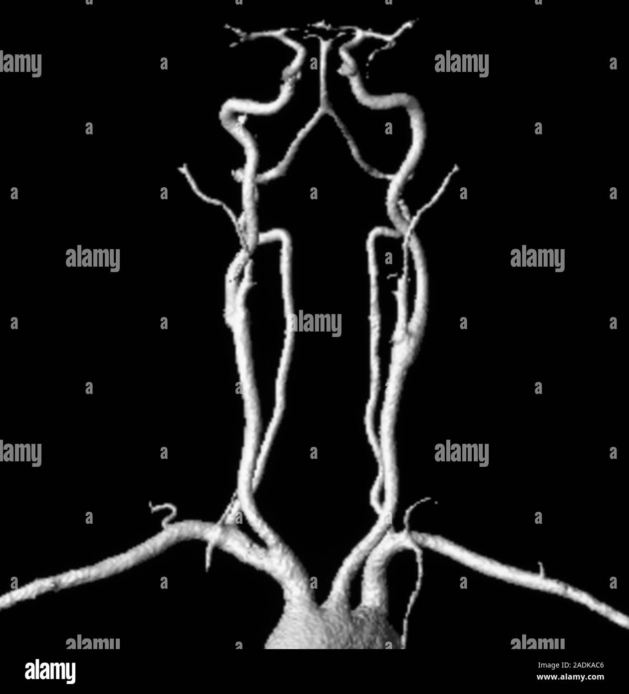 Chest, neck and head arteries. Magnetic resonance angiography (MRA ...