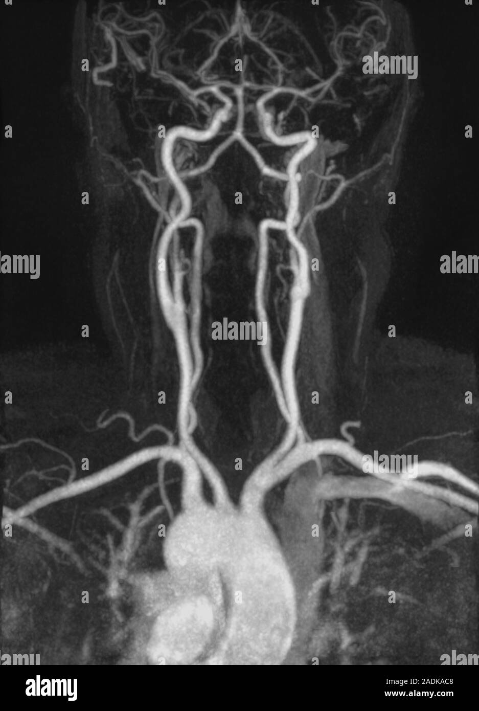 Chest, neck and head arteries. Magnetic resonance angiography (MRA ...