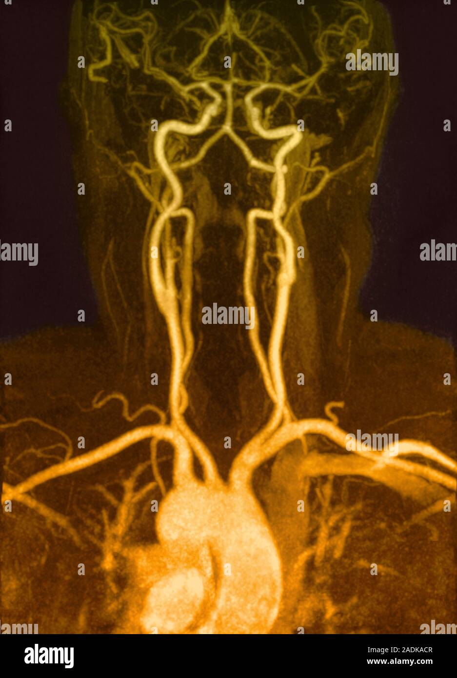 Chest, neck and head arteries. Coloured magnetic resonance angiography ...