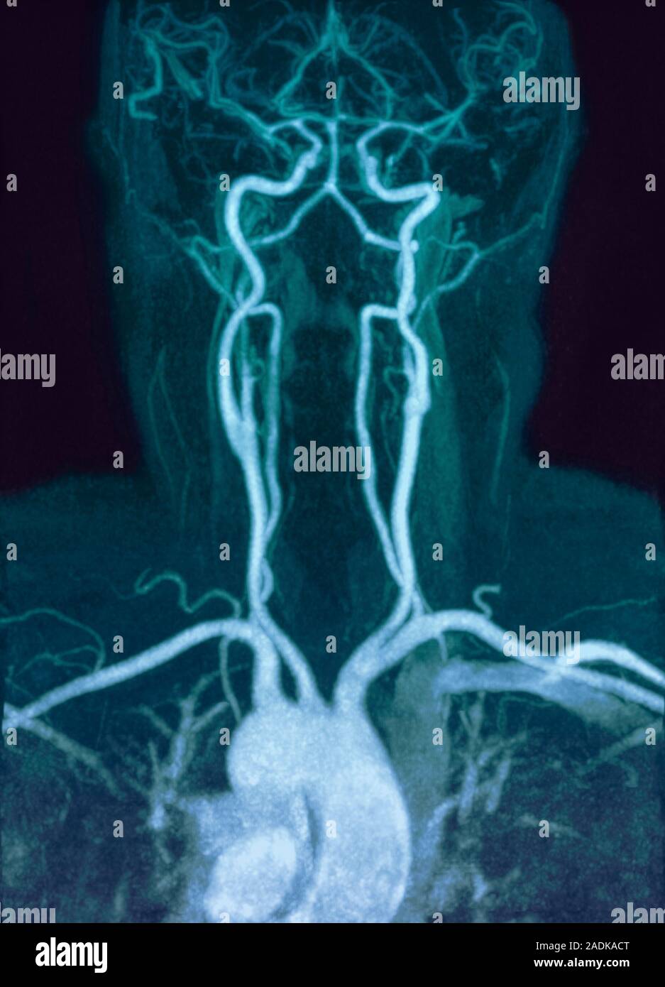 Chest, neck and head arteries. Coloured magnetic resonance angiography ...