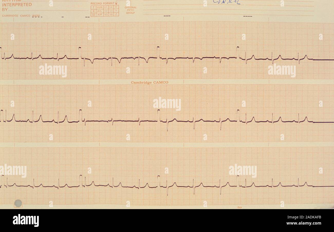 Electrocardiograph (ECG) read-out of a normal (control) heart Stock ...