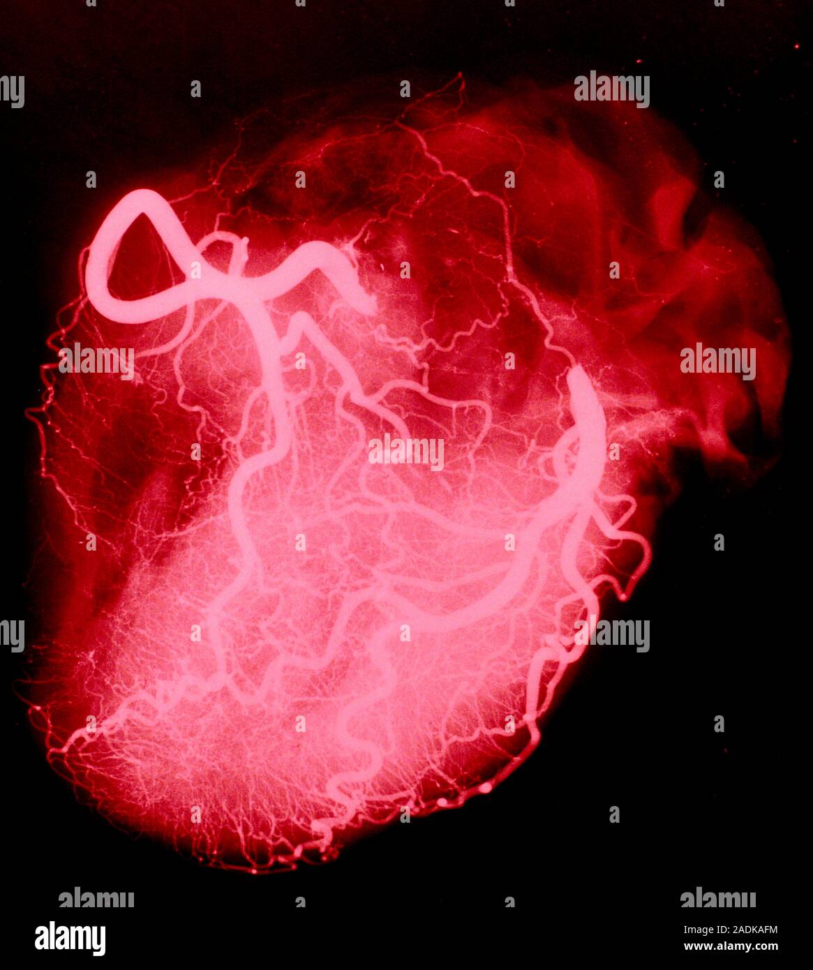 Arteriograph, tinted pink, of the coronary arteries of a normal heart ...