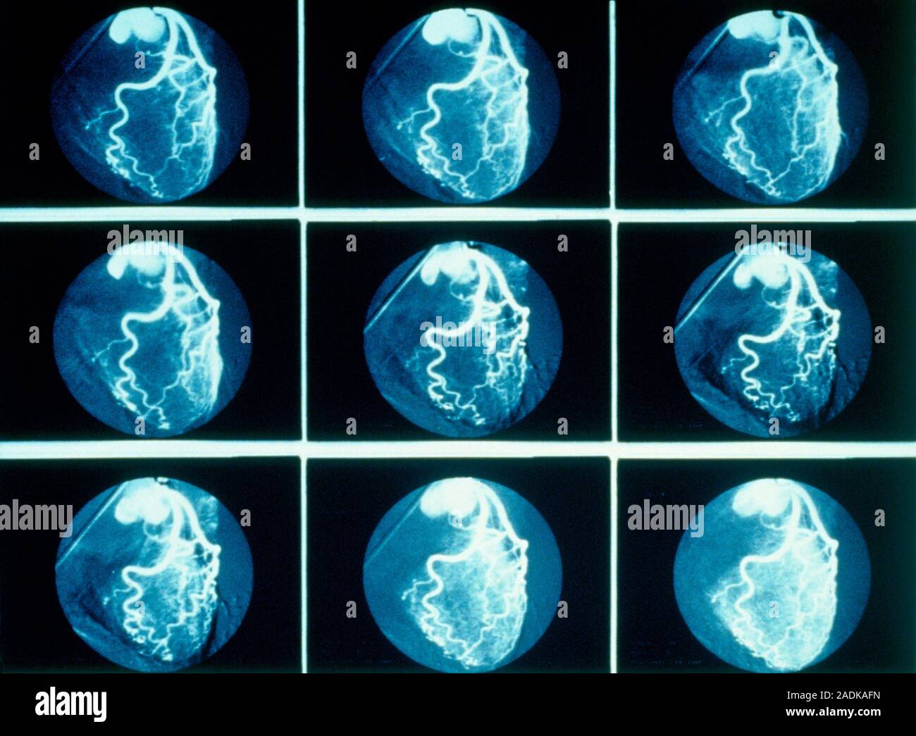 Series of 9 arteriograms of an infant's coronary arteries obtained ...