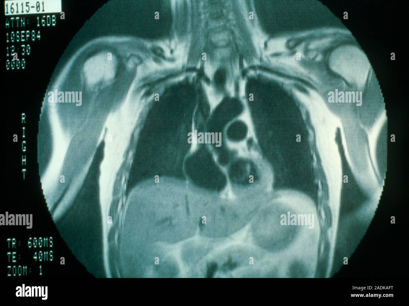 Nuclear magnetic resonance (NMR) image of the chest area of a normal ...