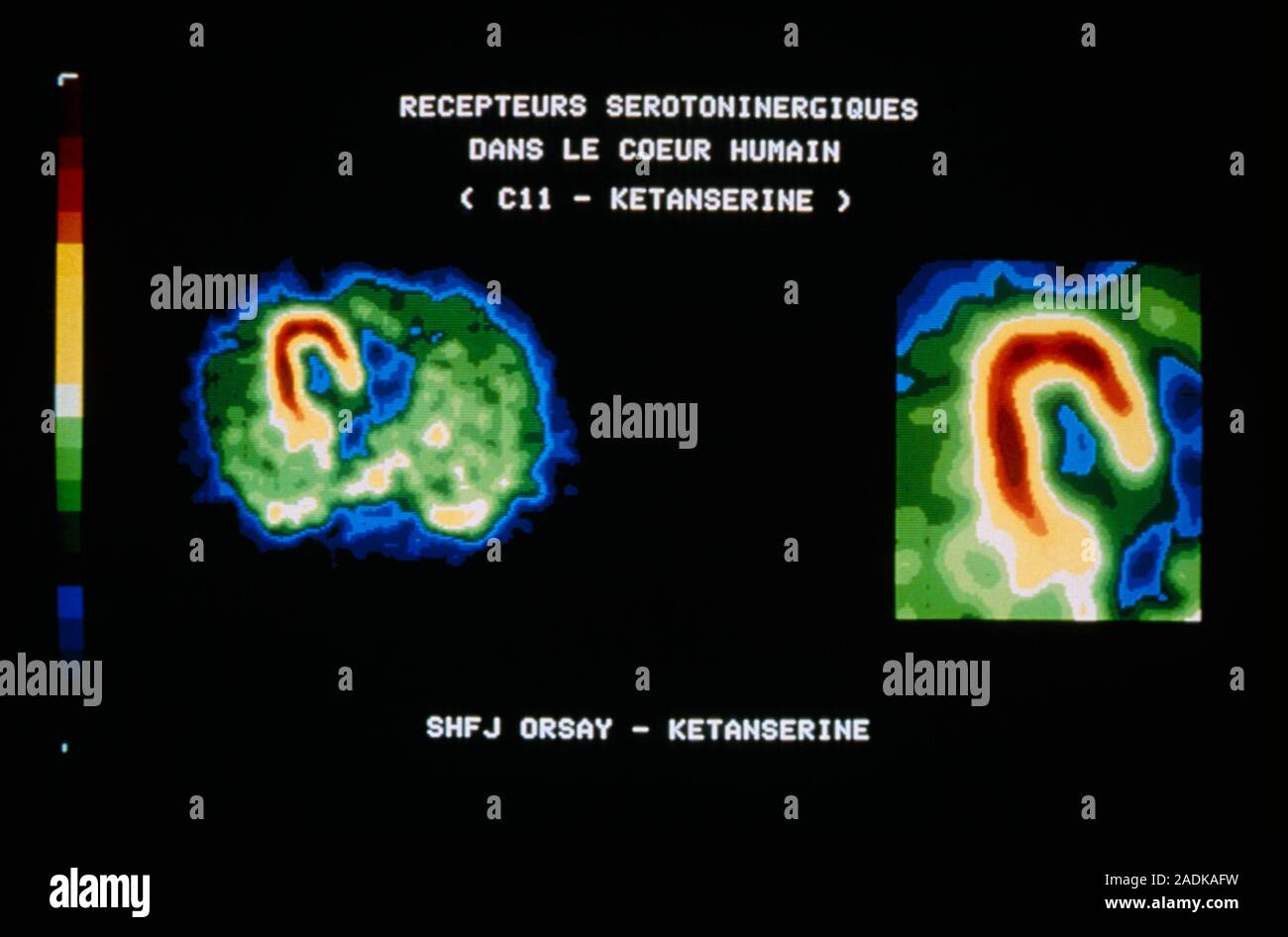 PET scan (positron emission tomography) of a normal human heart ...