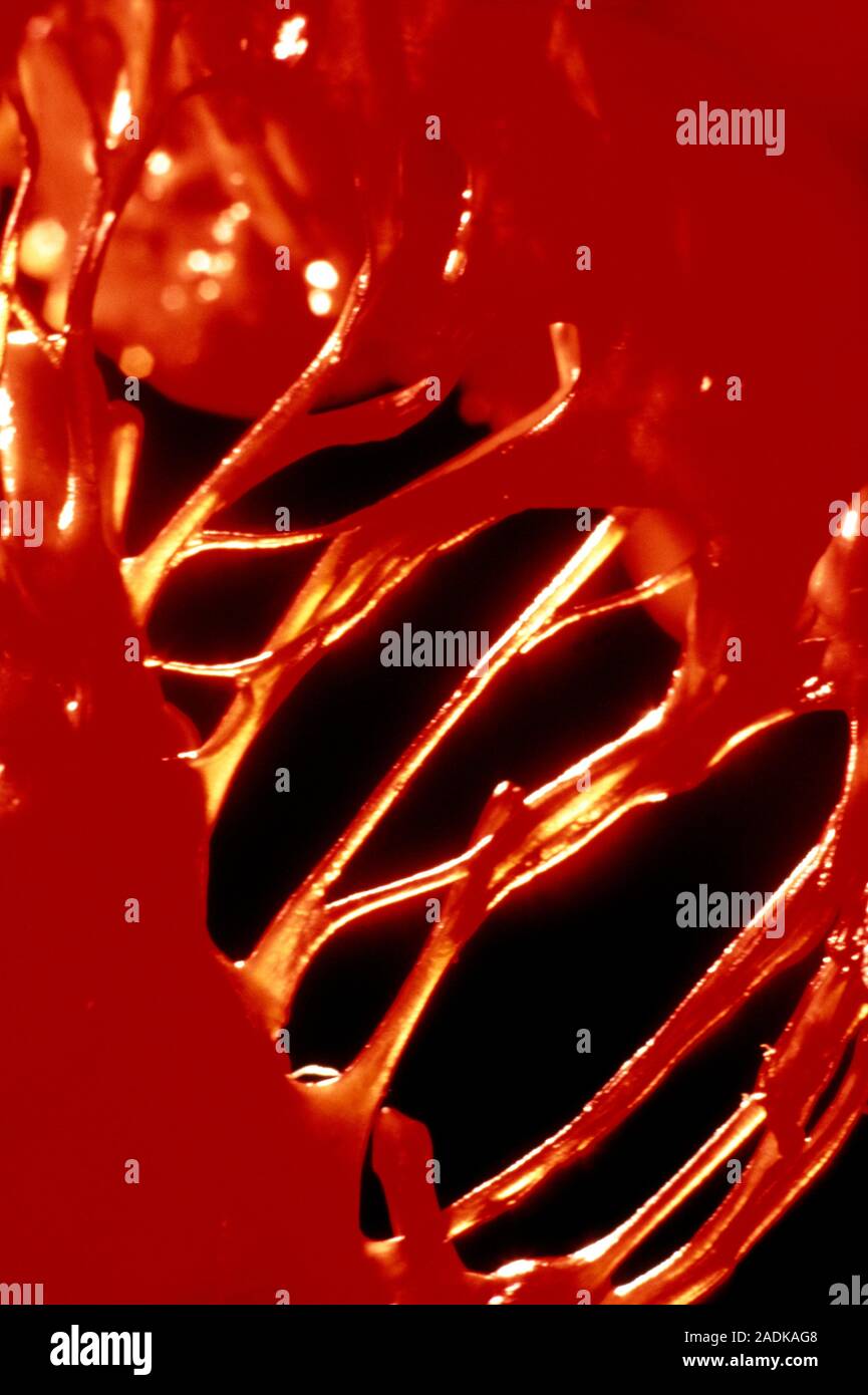 Macrophotograph of the chordae tendineae of the mitral valve in a human ...