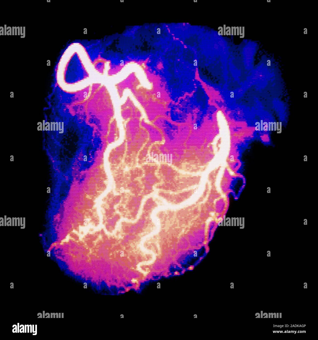False-colour coronary angiogram of a normal healthy heart. Angiography ...