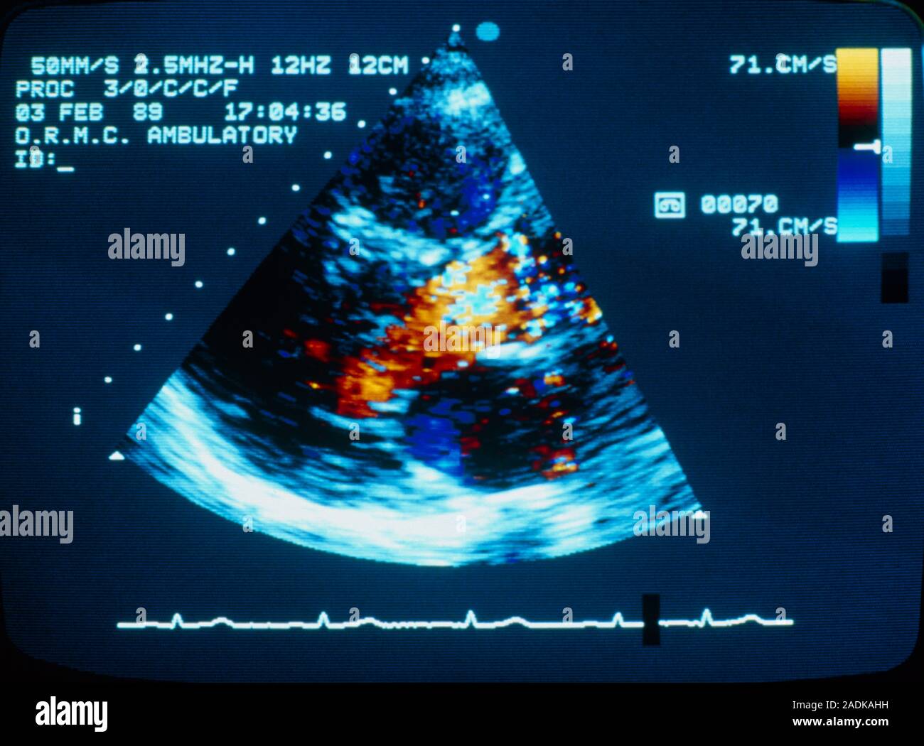 Normal heart. Coloured ultrasound image (echo- cardiogram) showing a ...