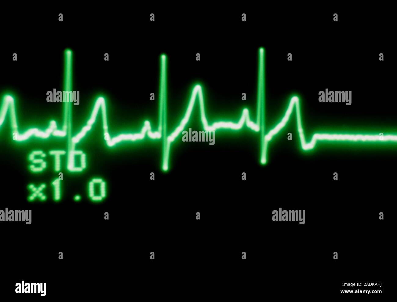 Normal heart trace. View of an electrocardiograph (ECG) readout ...