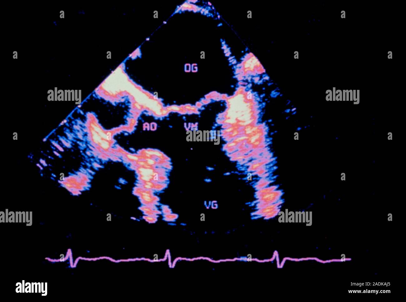 Echocardiogram. Coloured ultrasound image of the human heart, or ...