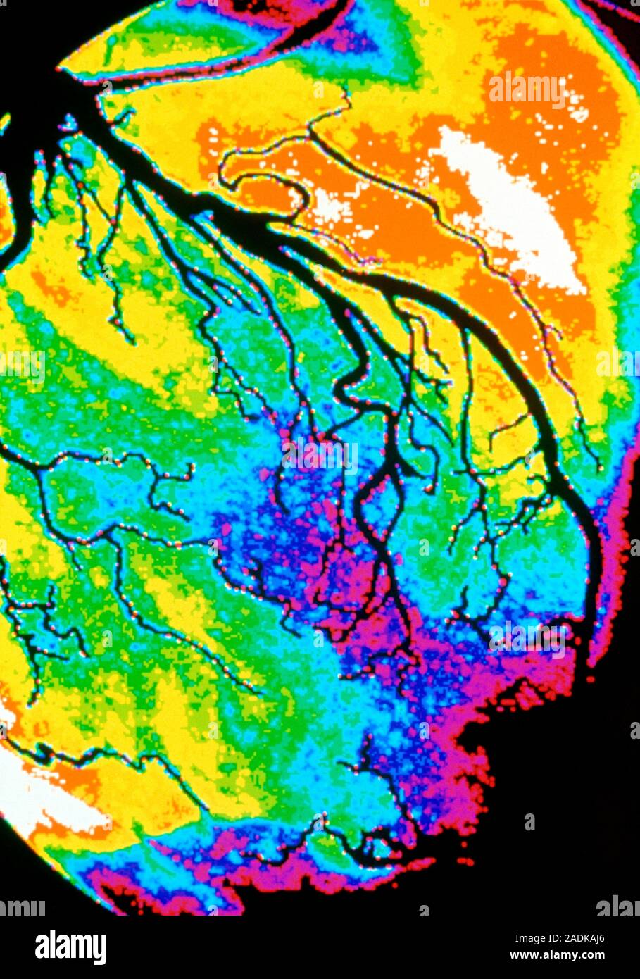Right coronary artery. Coloured X-ray angiogram of one of the arteries ...